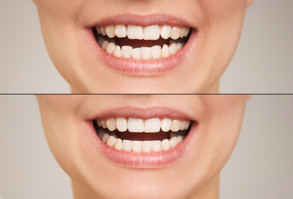 The Ultimate Guide to Orthodontic Treatments | The Tooth Spa